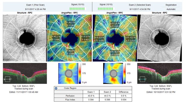 Zeiss Cirrus 5000 Angioplex - Insight Eye Equipment | Refurbished ...